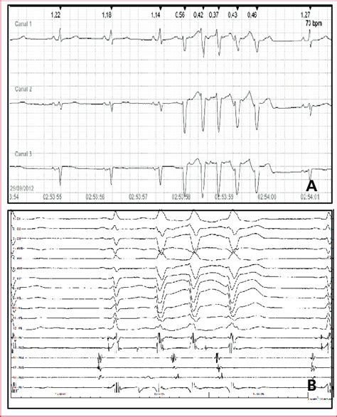 A Holter Monitoring Recording With Wide Qrs Ectopic Beats B