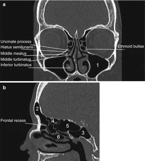Nasal Turbinates Xray