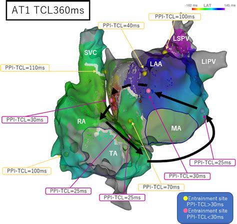 Bidirectional Rotating Biatrial Tachycardia Yamaoka 2023 Journal