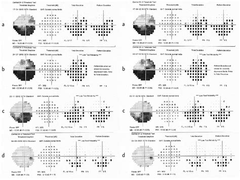 Serial Visual Fields Of The Right Eye Left And Left Eye Right