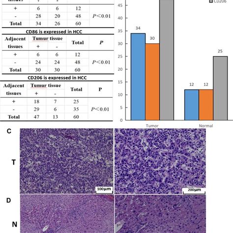 The Expression Statistics Of Pd L1 Cd86 And Cd206 In Liver Cancer