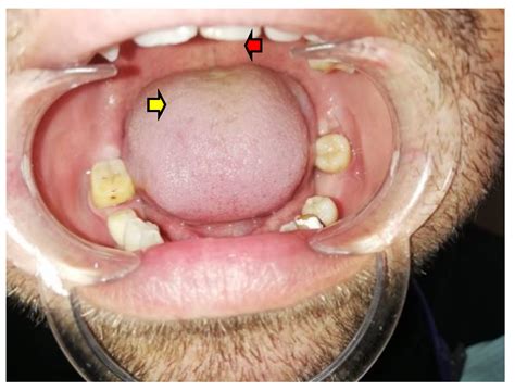 Addison Disease Histology