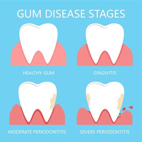 Stage 4 Periodontal Disease Periodontal Disease Pocono Periodontics