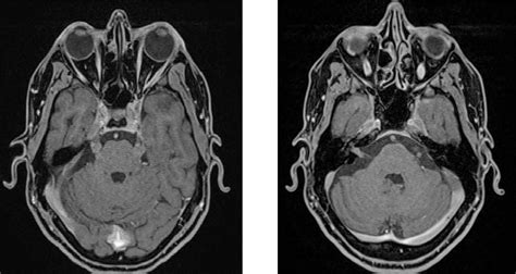 Figure 2 From Multiple Cranial Nerve Palsy Concomitant With Leptomeningeal Involvement In