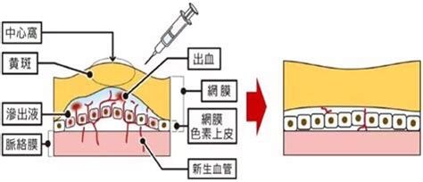 眼底出血or眼表出血 科普宣传 健康宣教 延安大学咸阳医院 中铁二十局中心医院 延安大学医学院第三附属医院 咸阳心脑血管病医院 居民医保定点医院