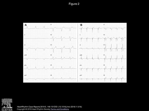 His Bundle Pacing In A Patient With Dextrocardia Severe Systolic Dysfunction And Complete