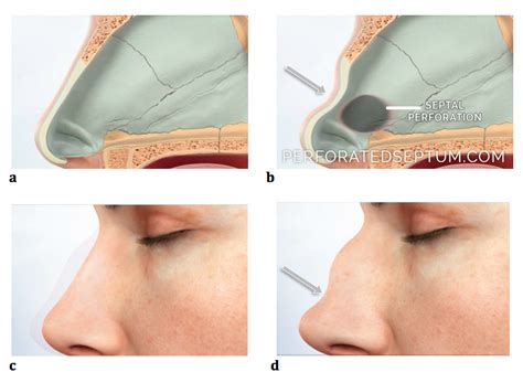 Is A Hole In Your Nose Dangerous At Christie Llamas Blog