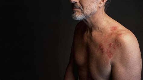 Shingles And Diabetes In Over 50 Stop Shingles