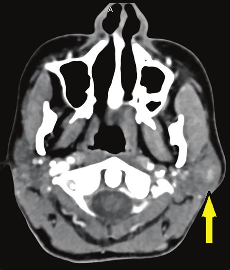Neck Ct Showing The Left Parotid Mass Arrow Download Scientific Diagram