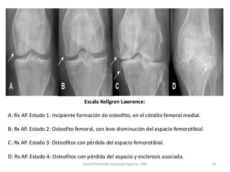 Bloc D´un Metge De Família Escala Kellgren Lawrence De Classificació