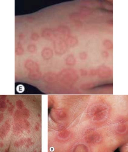 Fichas De Aprendizaje Eritema Multiforme EM Quizlet