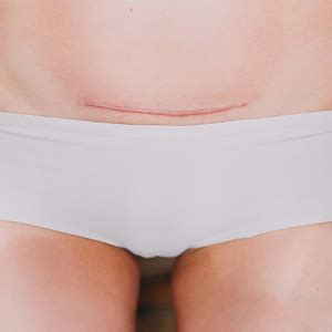 When Can You Have Sex After A C Section News