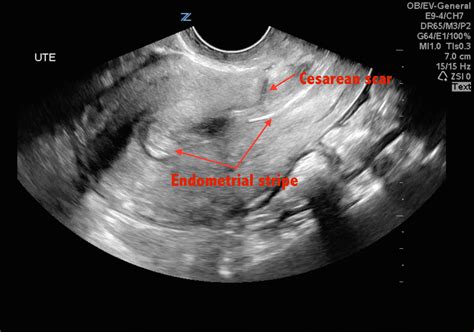 Hennepin Ultrasound Cesarean Scar Ectopic