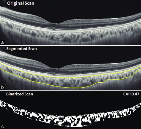 A The Original Swept Source Optical Coherence Tomography Ss Oct