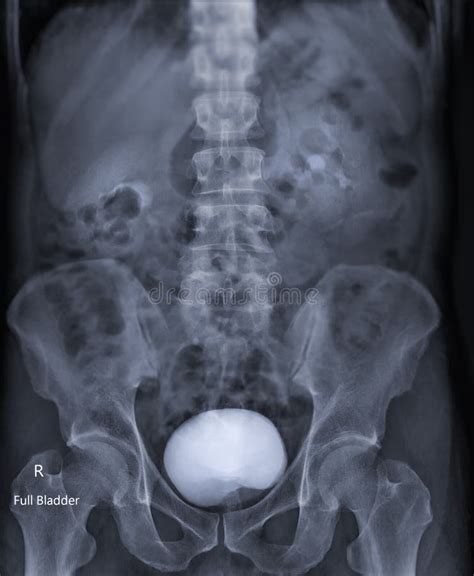 Intravenous Pyelogram Or I V P Stock Image Image Of Colic Adrenal
