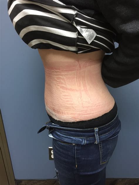 Patient A 6 Weeks Post Operative Tummy Tuck Oblique Image — Dr Giuffre Plastic Surgeon Edmonton