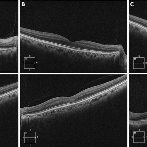 Outer Nuclear Layer High Definition Optical Coherence Tomography A At Download Scientific