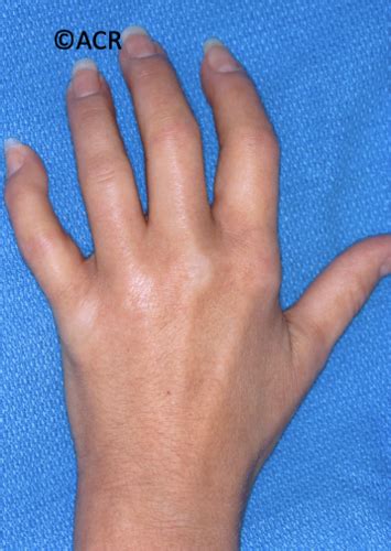 Systemic Sclerosis Sarcoidosis Flashcards Quizlet