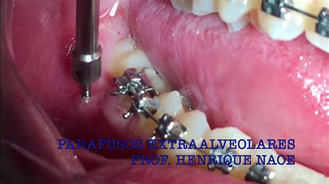 BUCCAL SHELF COM - YouTube