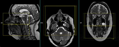 Trigeminal Neuralgia Mri