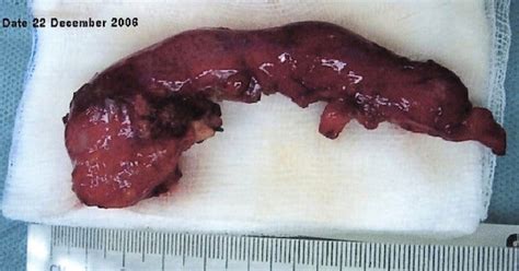 Pretty Useful Appendix Evolved More Than 30 Times WIRED