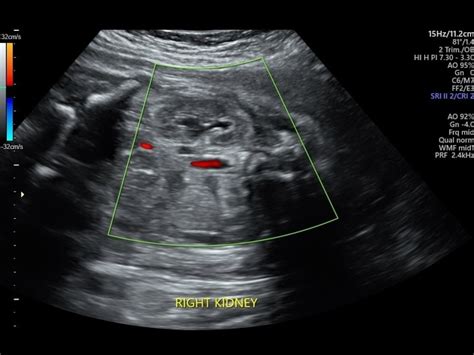 Pyelectasis Vs Pelviectasis