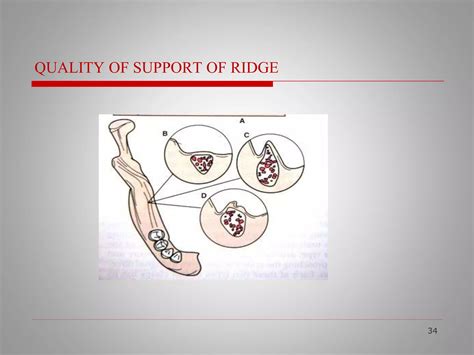 Designing For Kennedy Class I And Class Ii Ppt Oral Care Personal Care