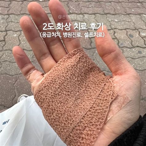 화상 시 응급처치 방법 어느 병원 가야할까 2도 화상 치료 후기 약국 화상연고 추천 네이버 블로그