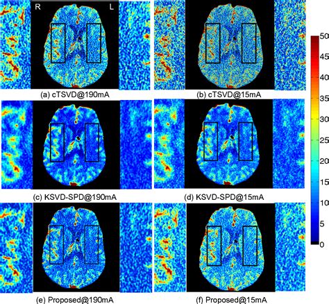 Figure 2 From Towards Robust Deconvolution Of Low Dose Perfusion Ct
