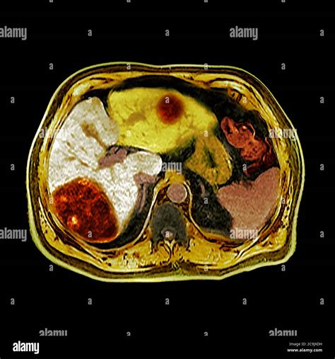 Liver Cancer Coloured Axial Computed Tomography Ct Scan Through The Abdomen Of An 80 Year Old