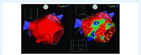 Electrogram Duration Maps The Left Panel Shows The Colour Coded Egm