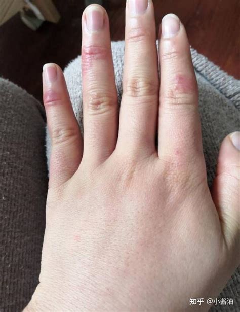 冻疮的注意事项是什么？以及解决方法 知乎