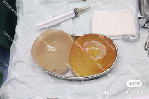 在胸部十几年的胸假体取出即刻是什么样子？ 术中取出的不同类型胸部硅胶假体 ， 哔哩哔哩
