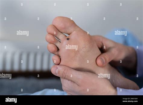 Man Checks Wart At Home After Cauterizing It With Celandine On Foot