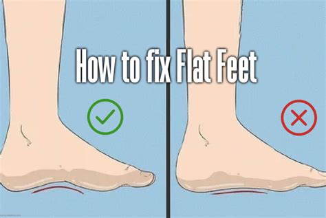How To Fix Duck Feet And Walk Properly Your Body Posture