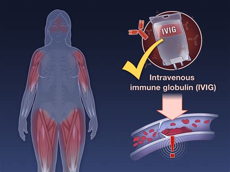 Ivig In Dermatomyositis Nejm
