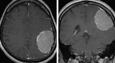 Convexity Meningioma The Neurosurgical Atlas By Aaron Cohen Gadol M D