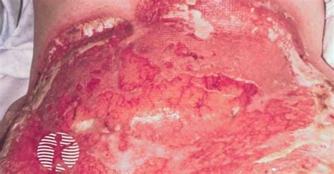 Pyoderma Gangrenosum Image