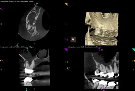 How To Differentiate Internal From External Resorption Root Canal Specialty Associates