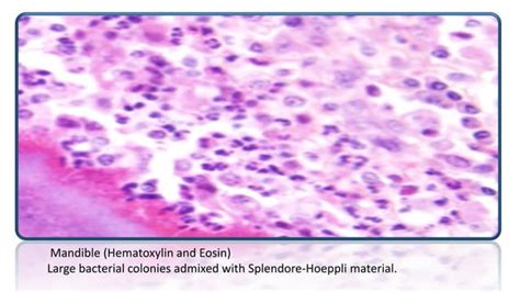 Actinomycosis Lumpy Jaw Pdf