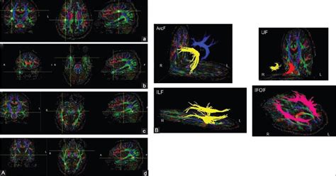 Analyzing Functional Structural And Anatomical Correlation Neurology India
