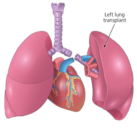 Lungs Clipart Lung Transplant Lungs Lung Transplant Double Lung