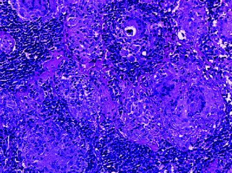 Lymph Node Biopsy With Non Caseating Granulomas Download Scientific