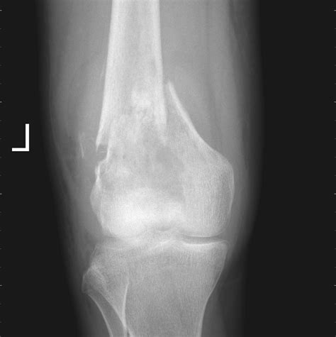 Osteosarcoma X Ray Codmans Triangle