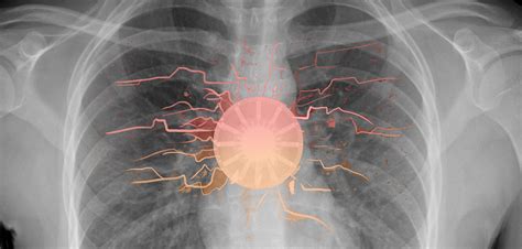 Ai For Medical Imaging — Detecting Anomalies With Variational