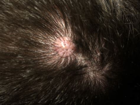 Cyst On Scalp Close Up Pic Mumsnet