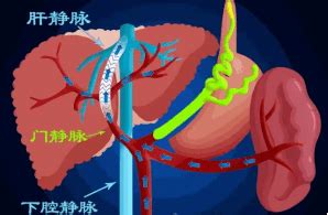 TIPS手术肝硬化门脉高压出血的最后一道防 门静脉 患者 治疗