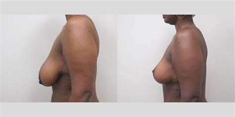 Large Breast Reduction Surgery For Black Woman In Her Late 40 S Before
