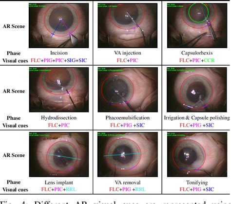 Figure 4 From Phase Specific Augmented Reality Guidance For Microscopic Cataract Surgery Using
