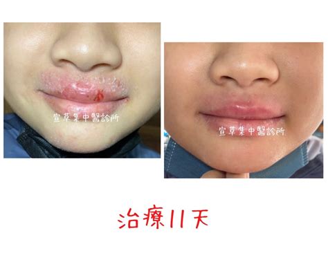 嘴唇周圍厚皮發炎口角炎，唇炎的三大種類，3種中醫中藥治療調養 Drsyuan宣草集中醫診所｜乾癬異位性皮膚炎專家